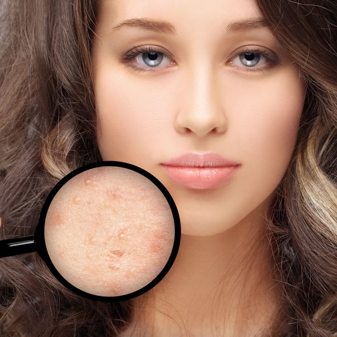 What Skin Conditions Can Be Treated With Microneedling? - Come And ...